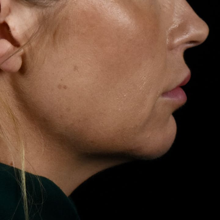 Sagging Neck | Dr Darren McKeown