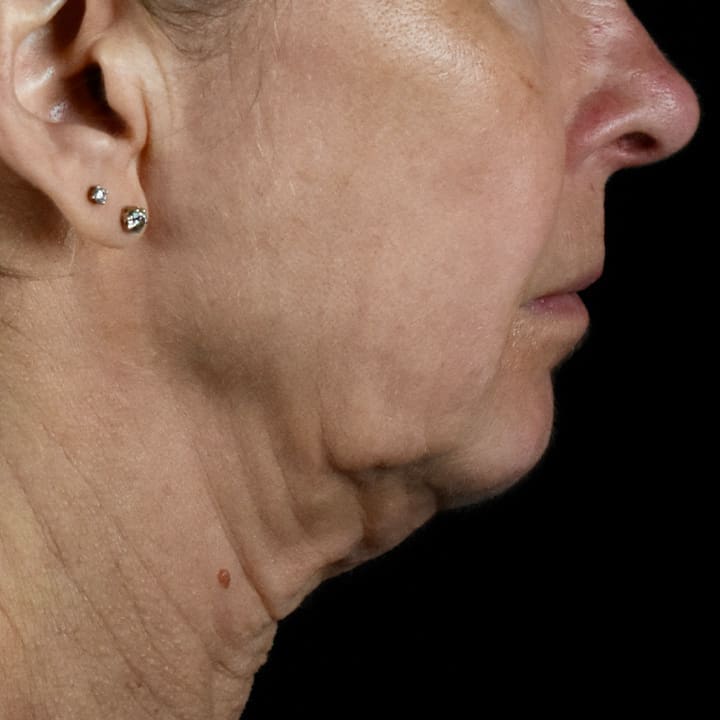 Jaw Contouring | Jaw Tightening | Dr Darren McKeown