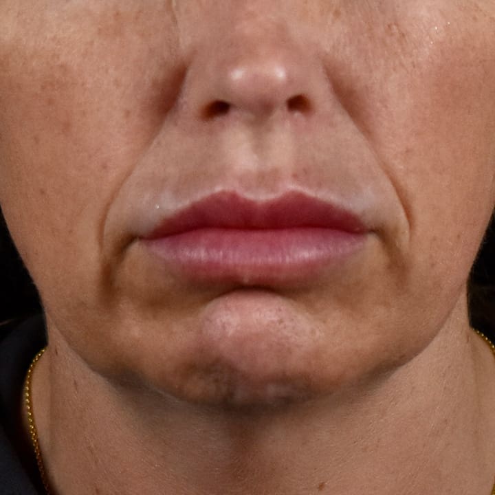 Chin Filler | Chin Augmentation | Dr Darrem McKeown