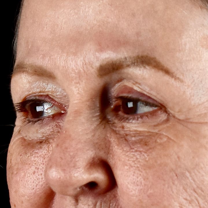 Laser Eye Lift | McKeown Medical