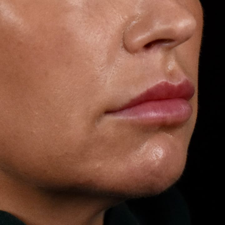 Jaw Contouring | Jaw Tightening | Dr Darren McKeown